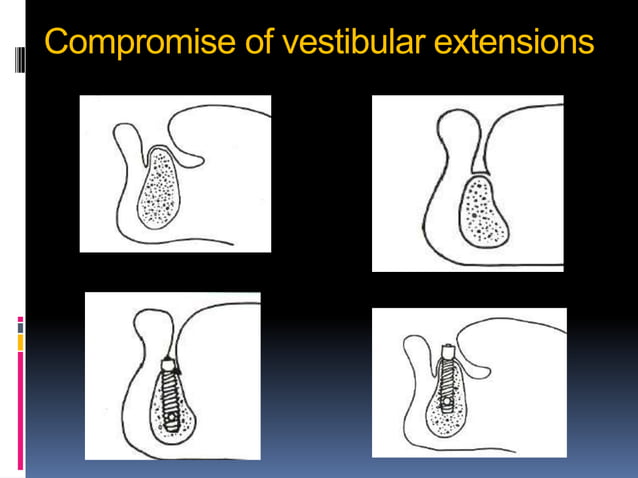 Prosthodontic rehabilitation of mandibulectomy | PPTX