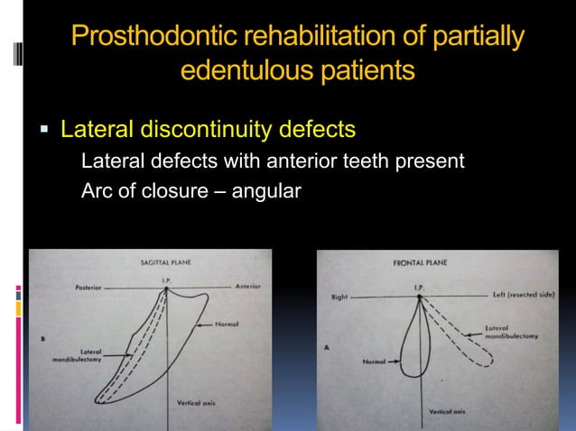 Prosthodontic rehabilitation of mandibulectomy | PPTX