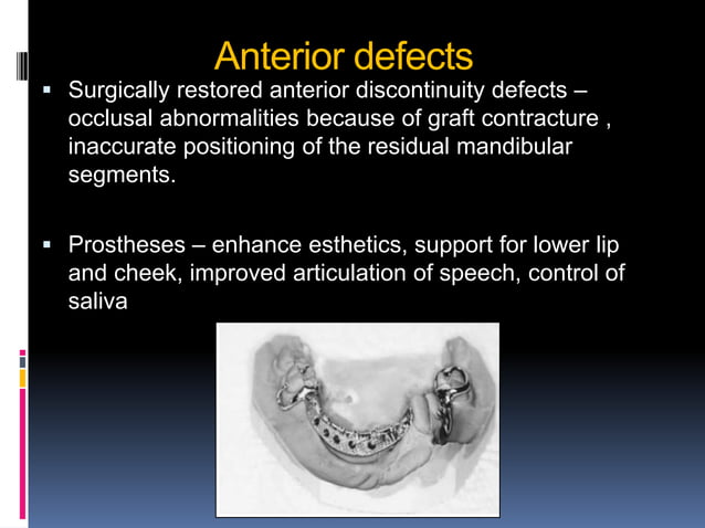 Prosthodontic rehabilitation of mandibulectomy | PPTX