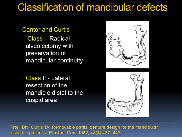 Prosthodontic rehabilitation of mandibulectomy | PPTX