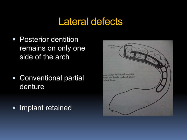 Prosthodontic rehabilitation of mandibulectomy | PPTX