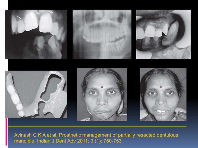 Prosthodontic rehabilitation of mandibulectomy | PPTX