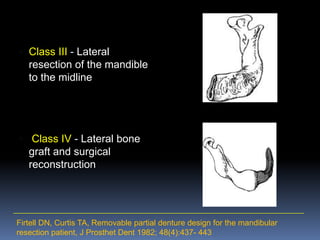 Prosthodontic rehabilitation of mandibulectomy | PPTX
