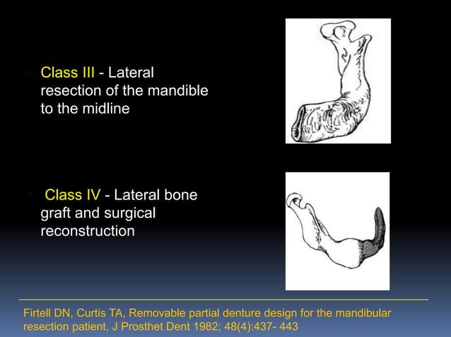 Prosthodontic rehabilitation of mandibulectomy | PPTX