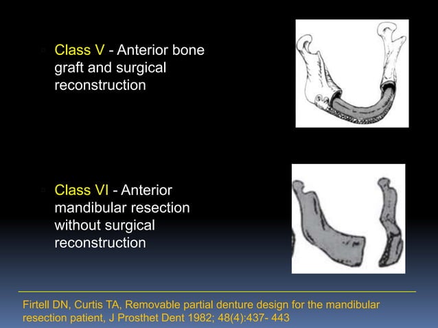 Prosthodontic rehabilitation of mandibulectomy | PPTX