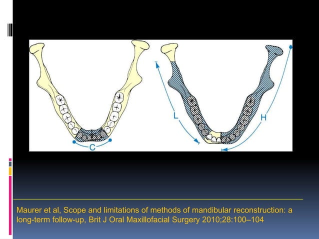 Prosthodontic rehabilitation of mandibulectomy | PPTX