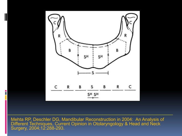 Prosthodontic rehabilitation of mandibulectomy | PPTX