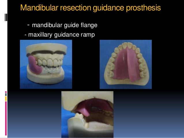 Prosthodontic rehabilitation of mandibulectomy