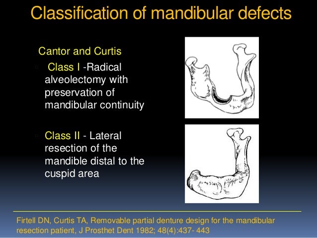 Prosthodontic rehabilitation of mandibulectomy