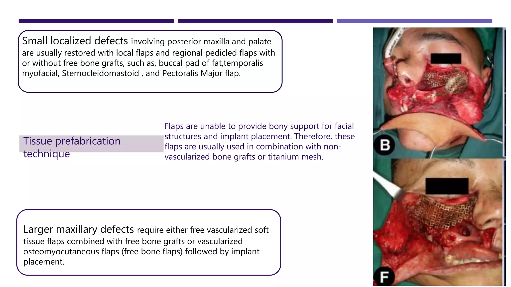 Prosthodontic rehabilitation of maxillary defect in a patient | PPTX