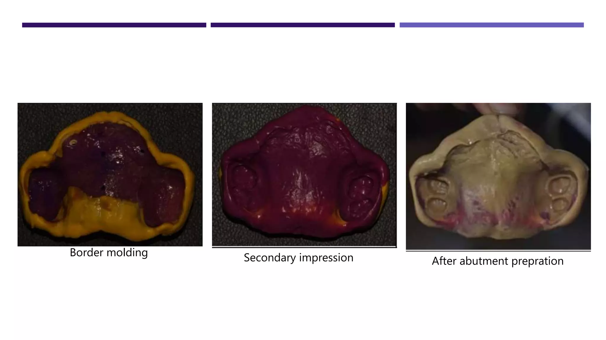 Prosthodontic rehabilitation of maxillary defect in a patient | PPTX