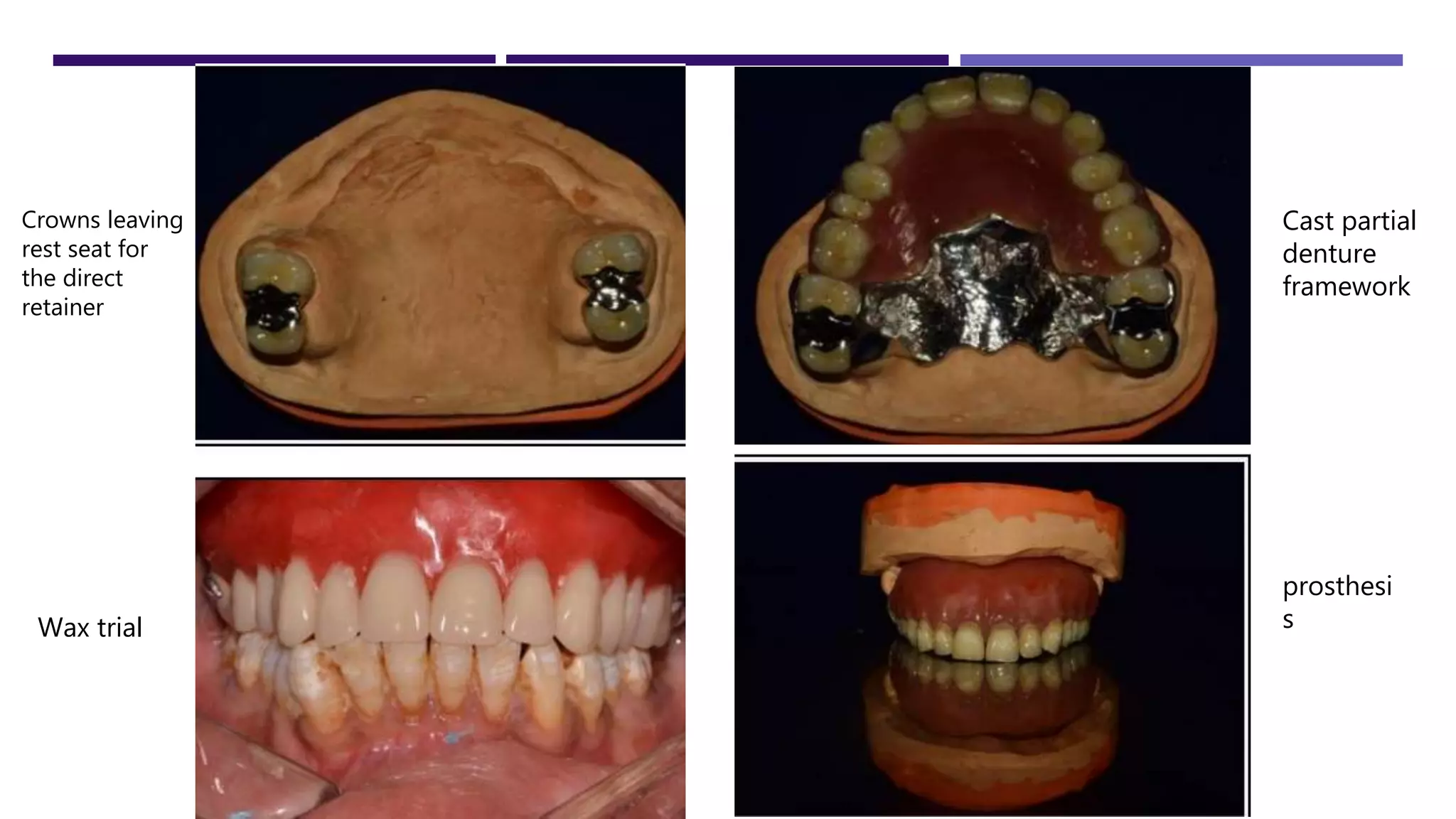 Prosthodontic rehabilitation of maxillary defect in a patient | PPTX