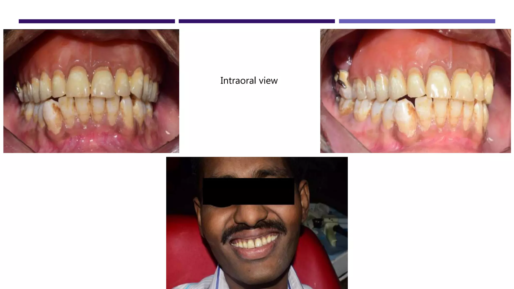 Prosthodontic rehabilitation of maxillary defect in a patient | PPTX
