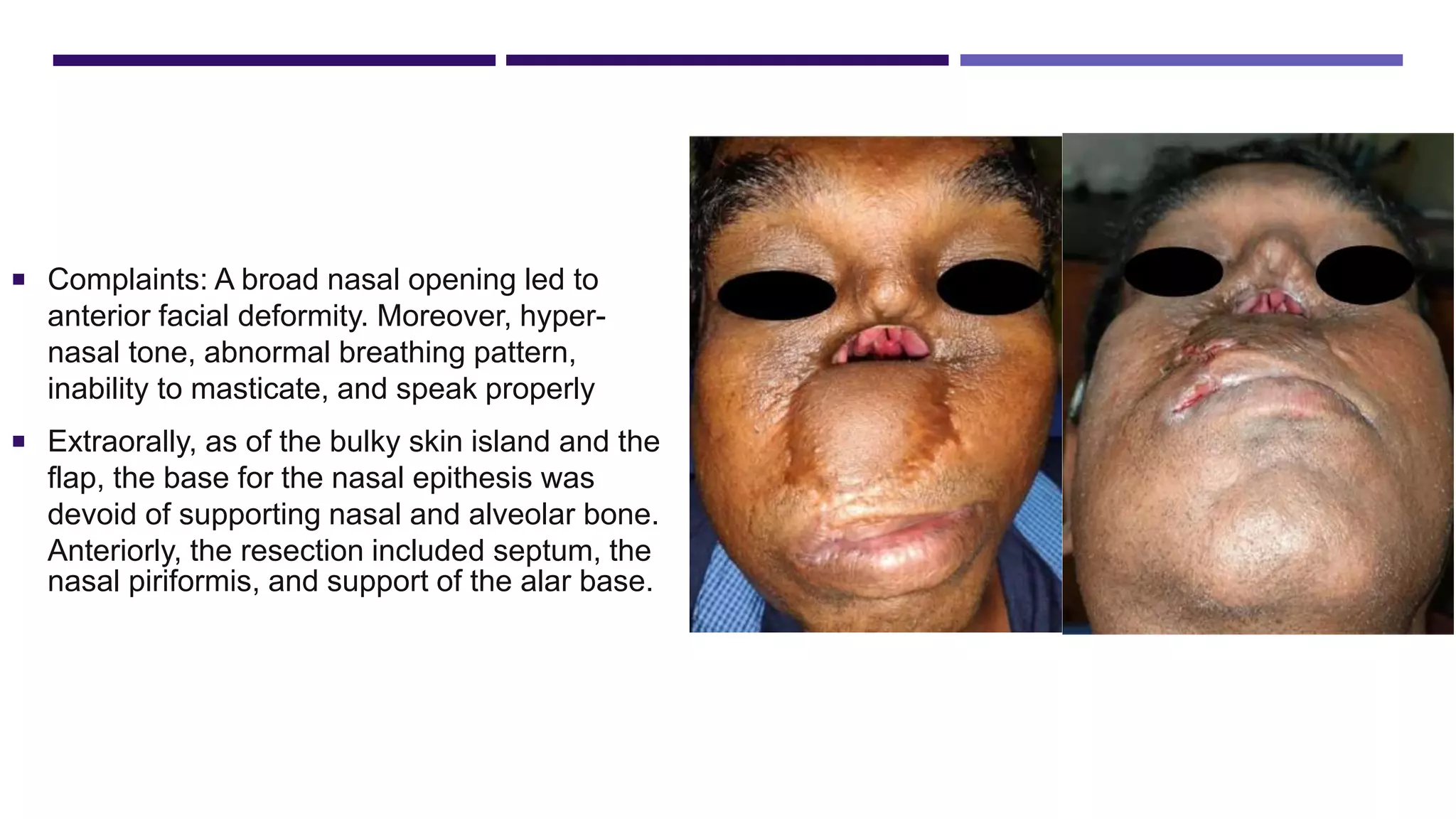 Prosthodontic rehabilitation of maxillary defect in a patient | PPTX