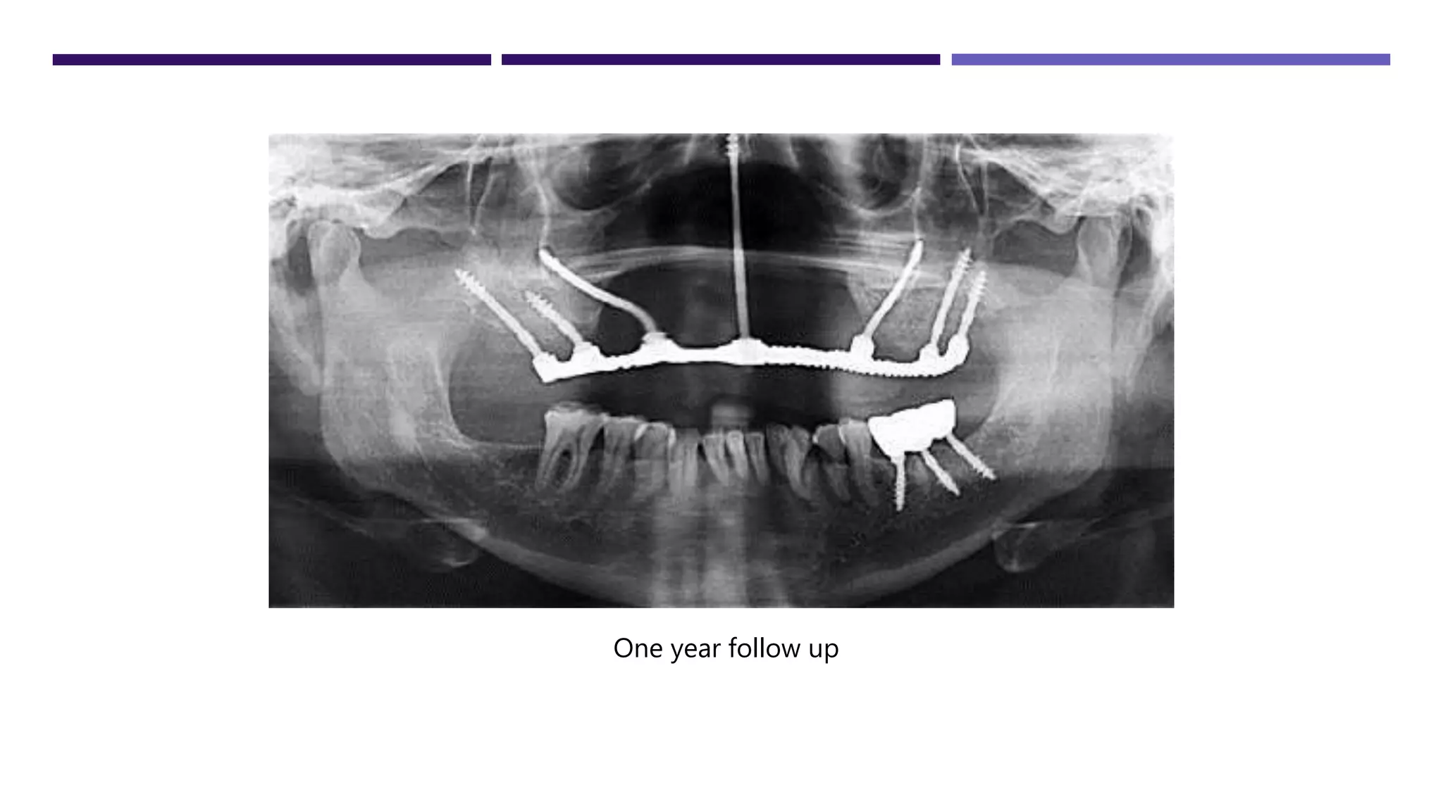 Prosthodontic rehabilitation of maxillary defect in a patient | PPTX