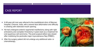 Prosthodontic rehabilitation of maxillary defect in a patient | PPTX