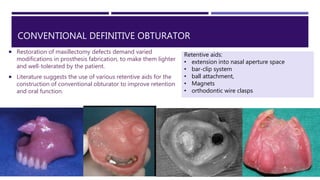 Prosthodontic rehabilitation of maxillary defect in a patient | PPTX