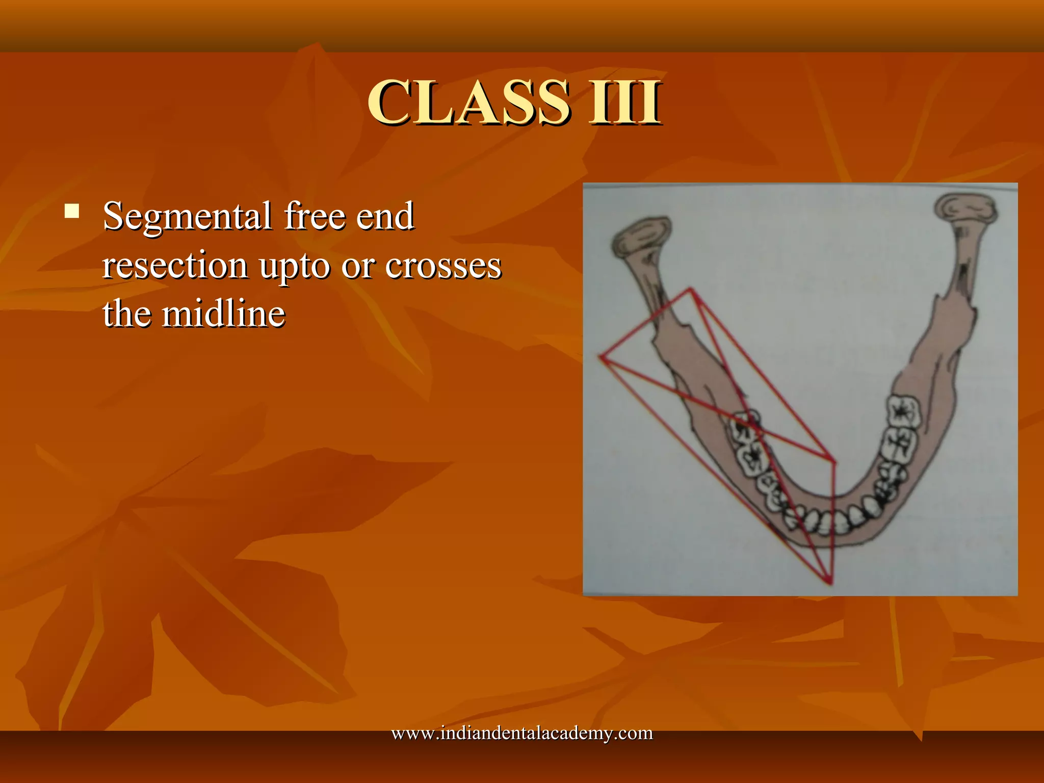 Prosthodontic rehabilitation of the mandibulectomy patient | PPT