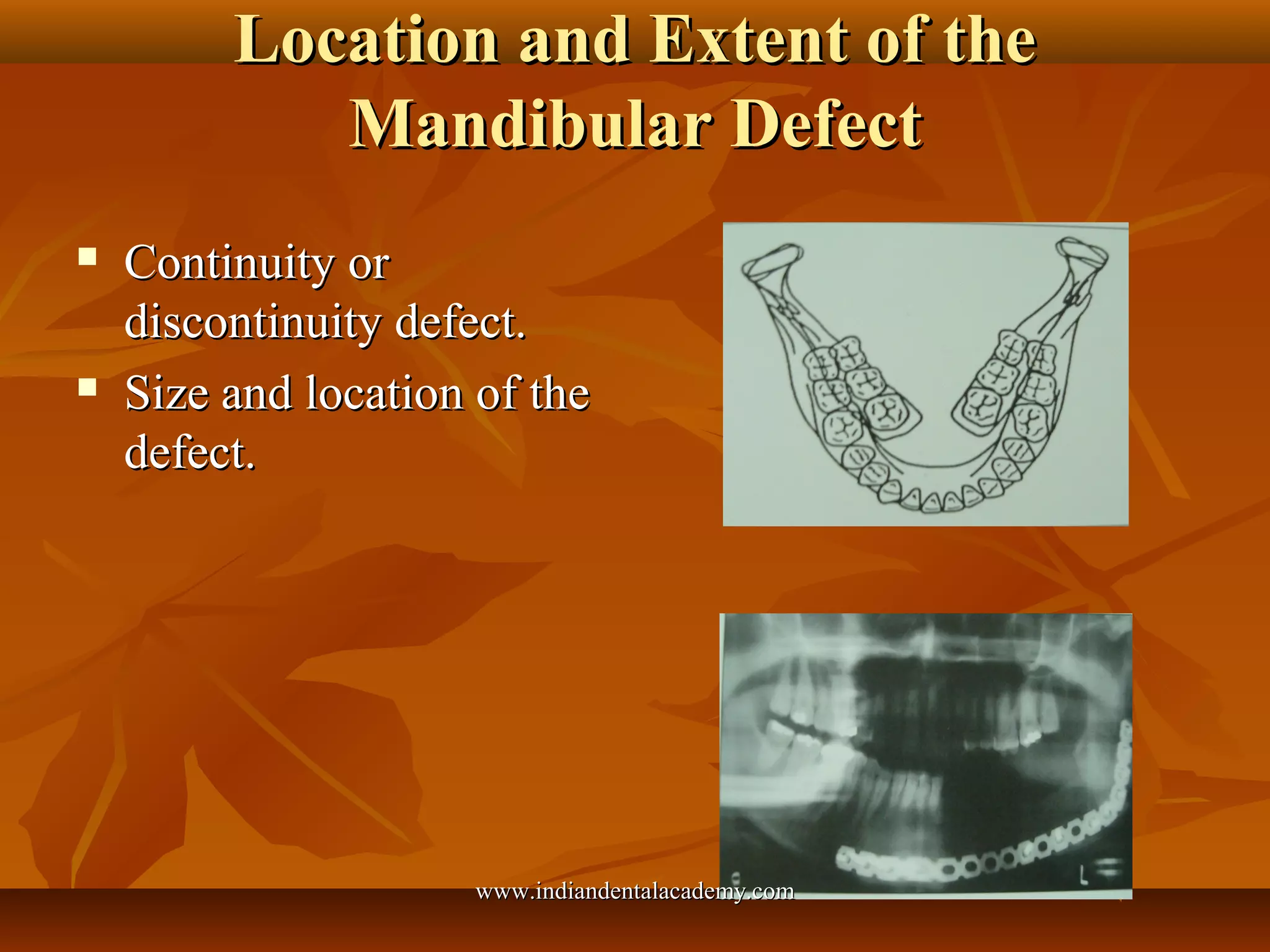 Prosthodontic rehabilitation of the mandibulectomy patient | PPT