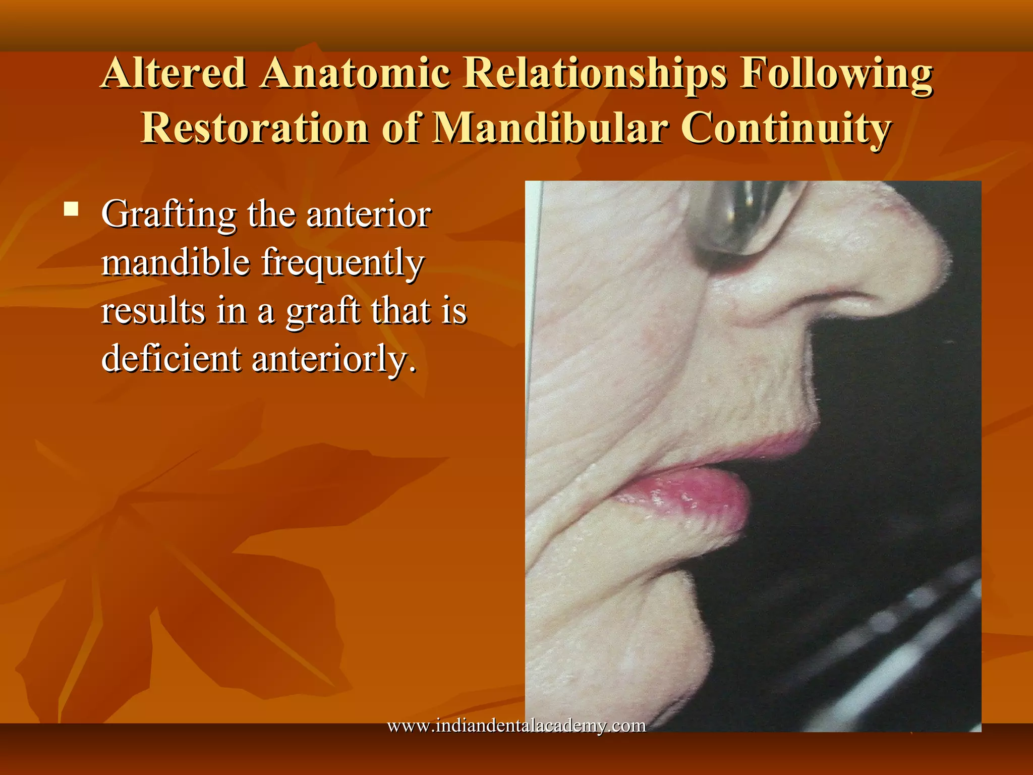 Prosthodontic rehabilitation of the mandibulectomy patient | PPT