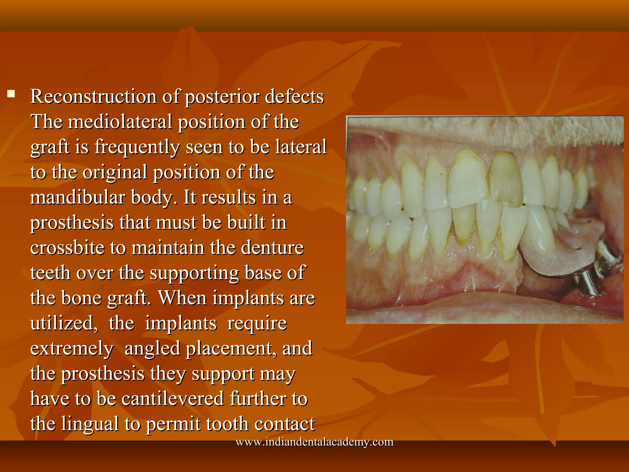 Prosthodontic rehabilitation of the mandibulectomy patient | PPT