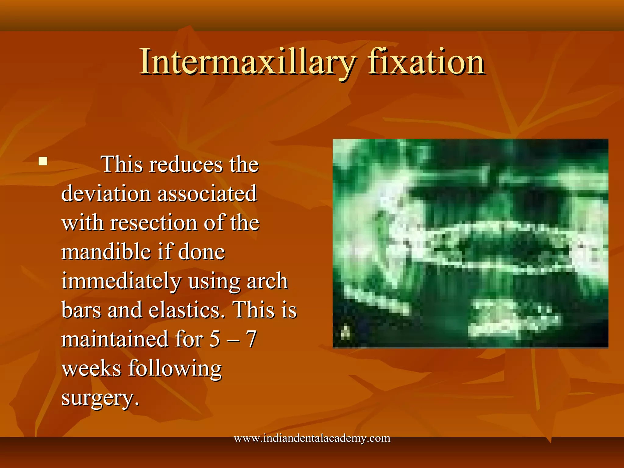 Prosthodontic rehabilitation of the mandibulectomy patient | PPT