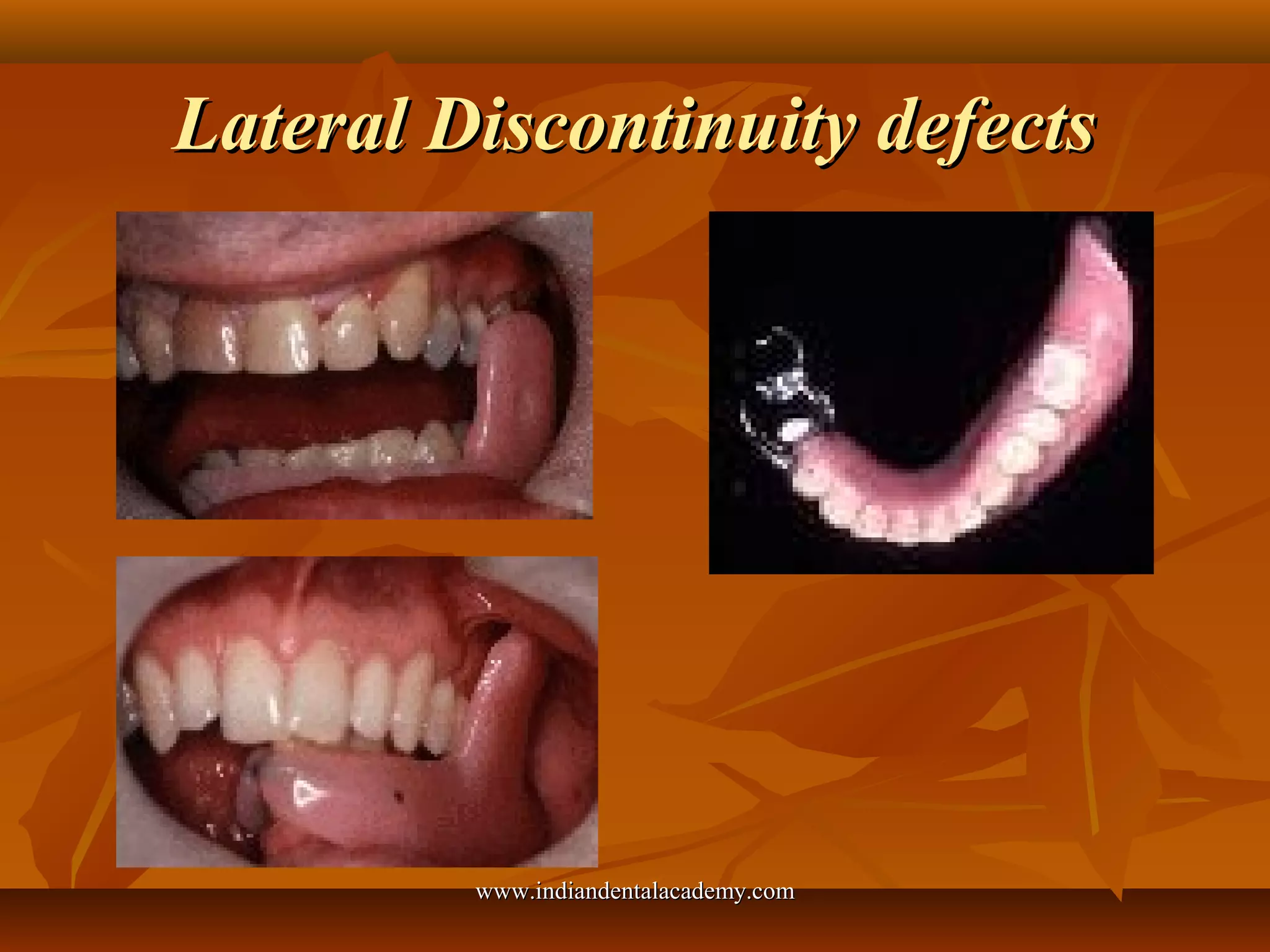 Prosthodontic rehabilitation of the mandibulectomy patient | PPT