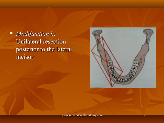 Prosthodontic rehabilitation of the mandibulectomy patient | PPT ...