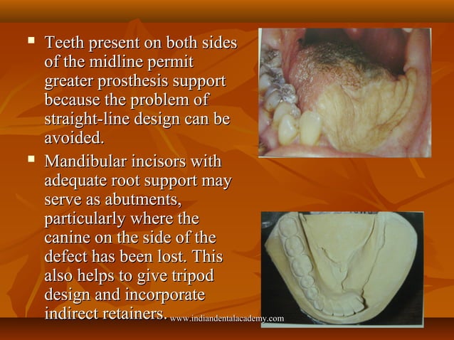 Prosthodontic rehabilitation of the mandibulectomy patient | PPT ...