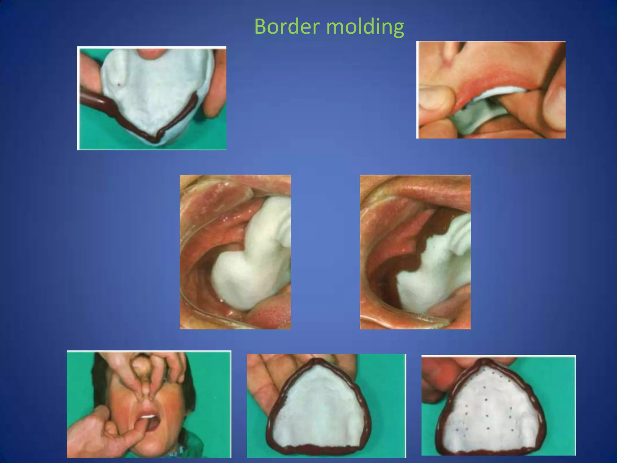 impression techniques of complete denture | PPTX
