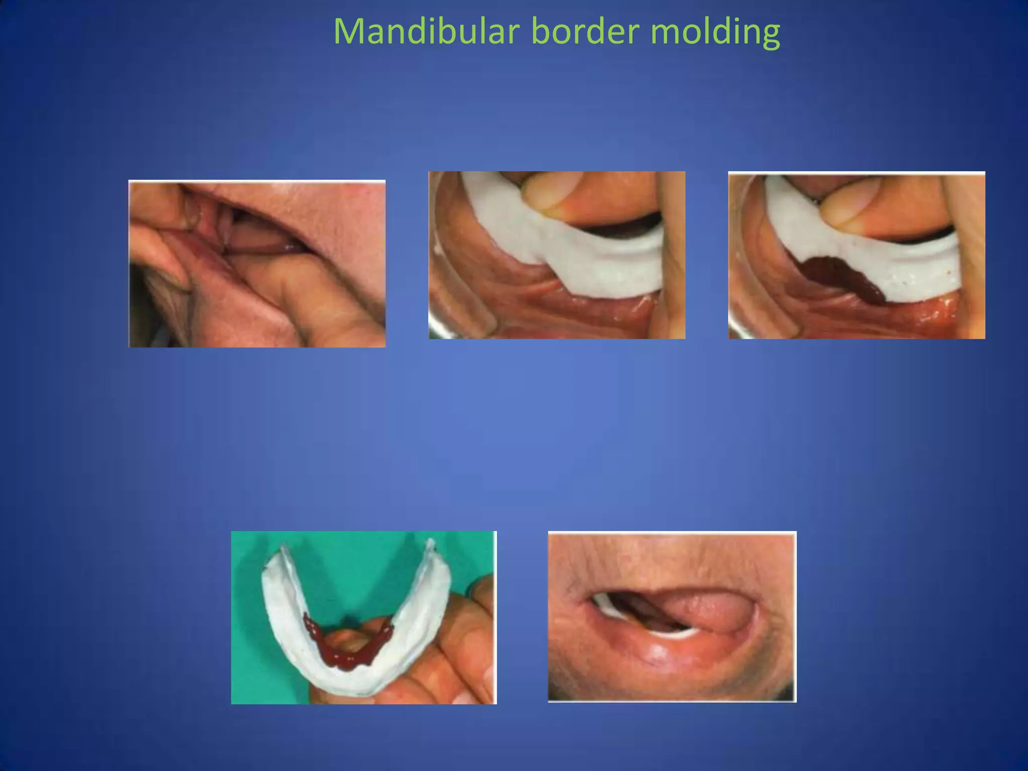 impression techniques of complete denture | PPTX