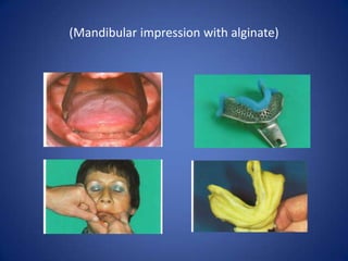 impression techniques of complete denture | PPTX