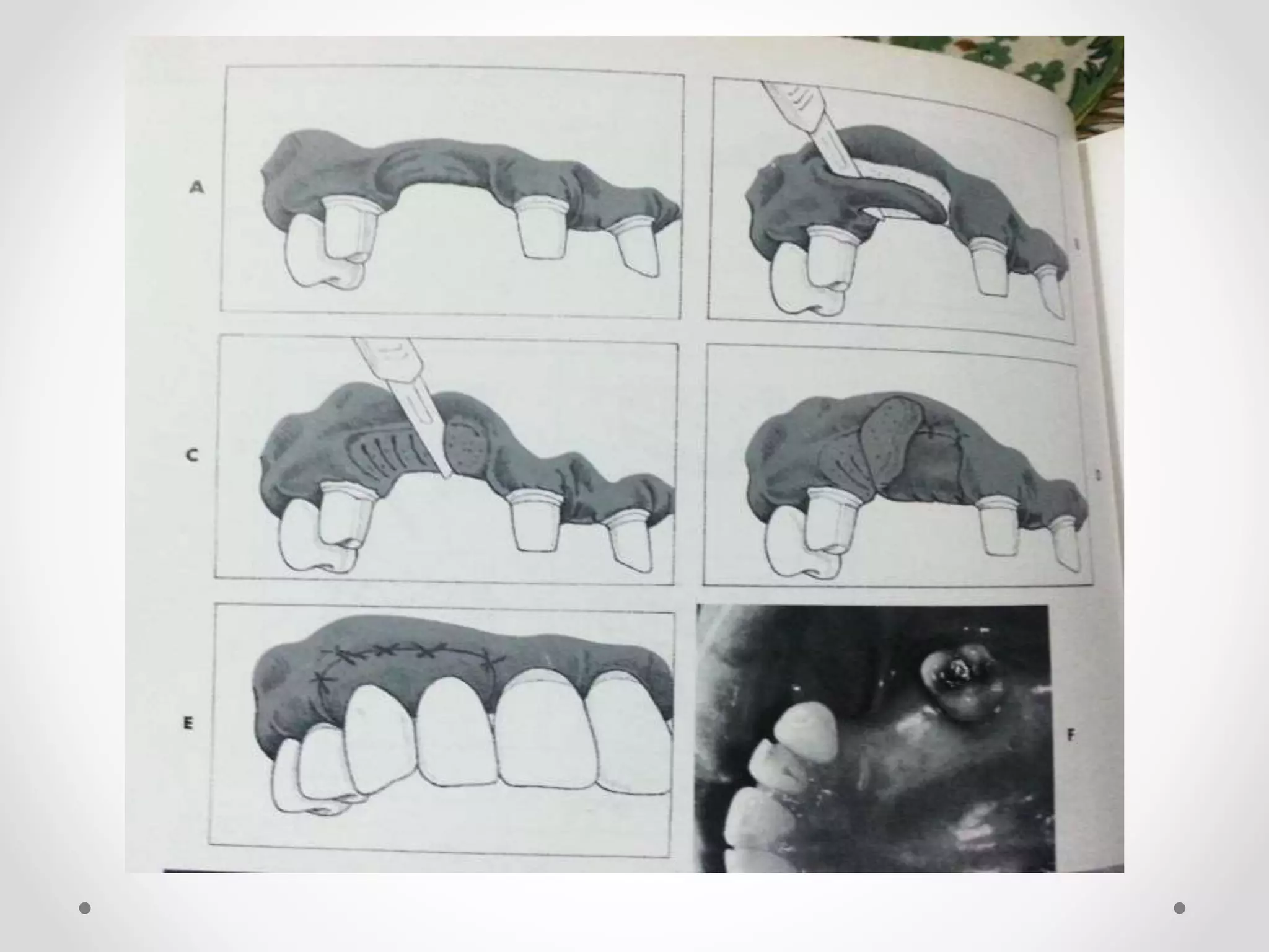 pontics in FPD (prosthodontics) | PPTX
