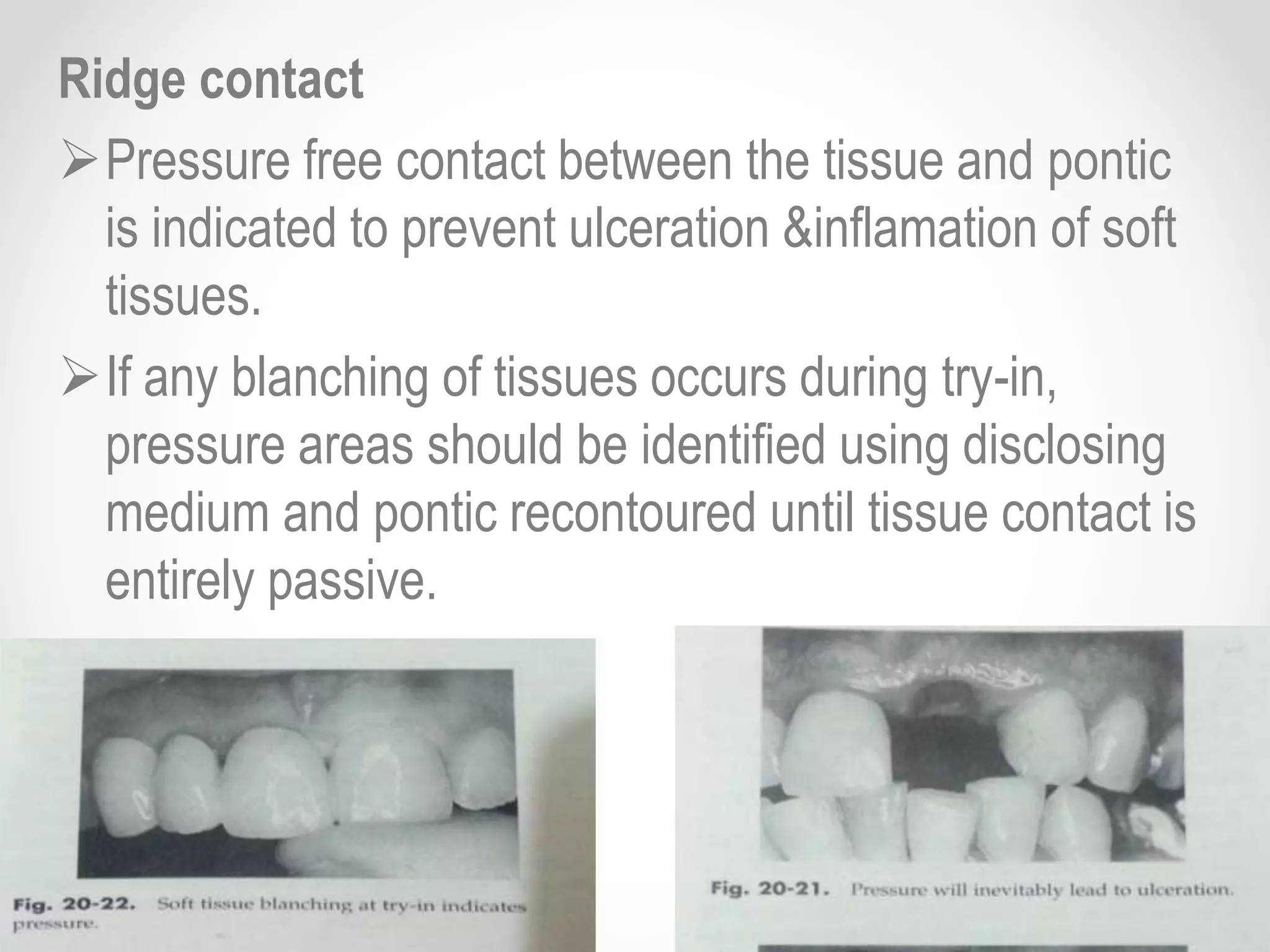 pontics in FPD (prosthodontics) | PPTX