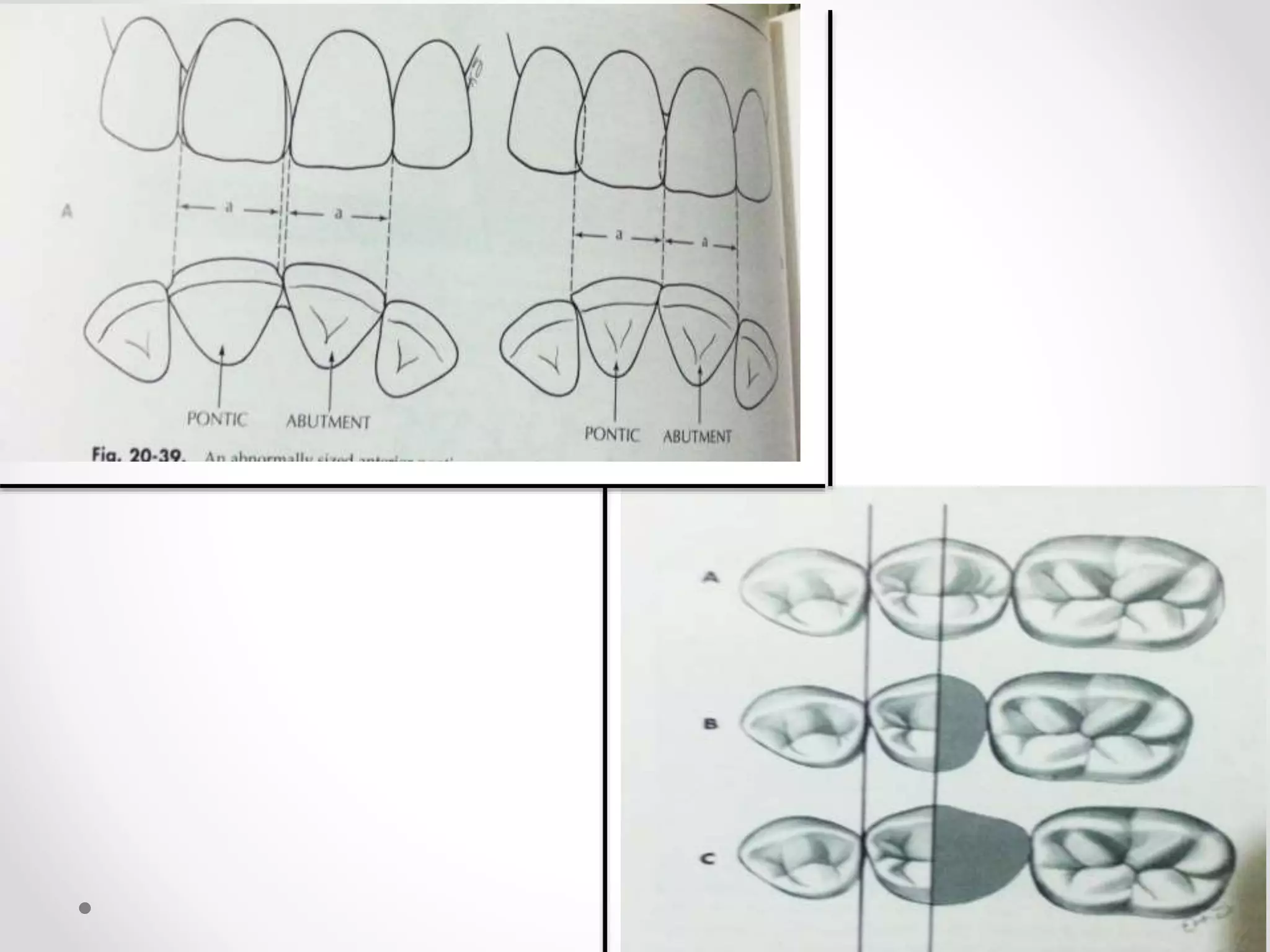 pontics in FPD (prosthodontics) | PPTX
