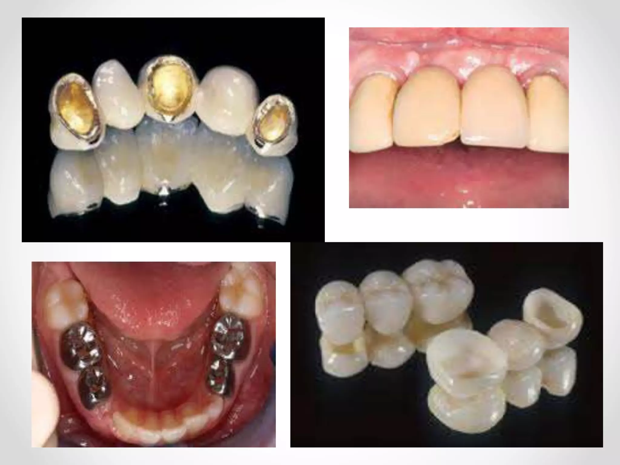 pontics in FPD (prosthodontics) | PPTX