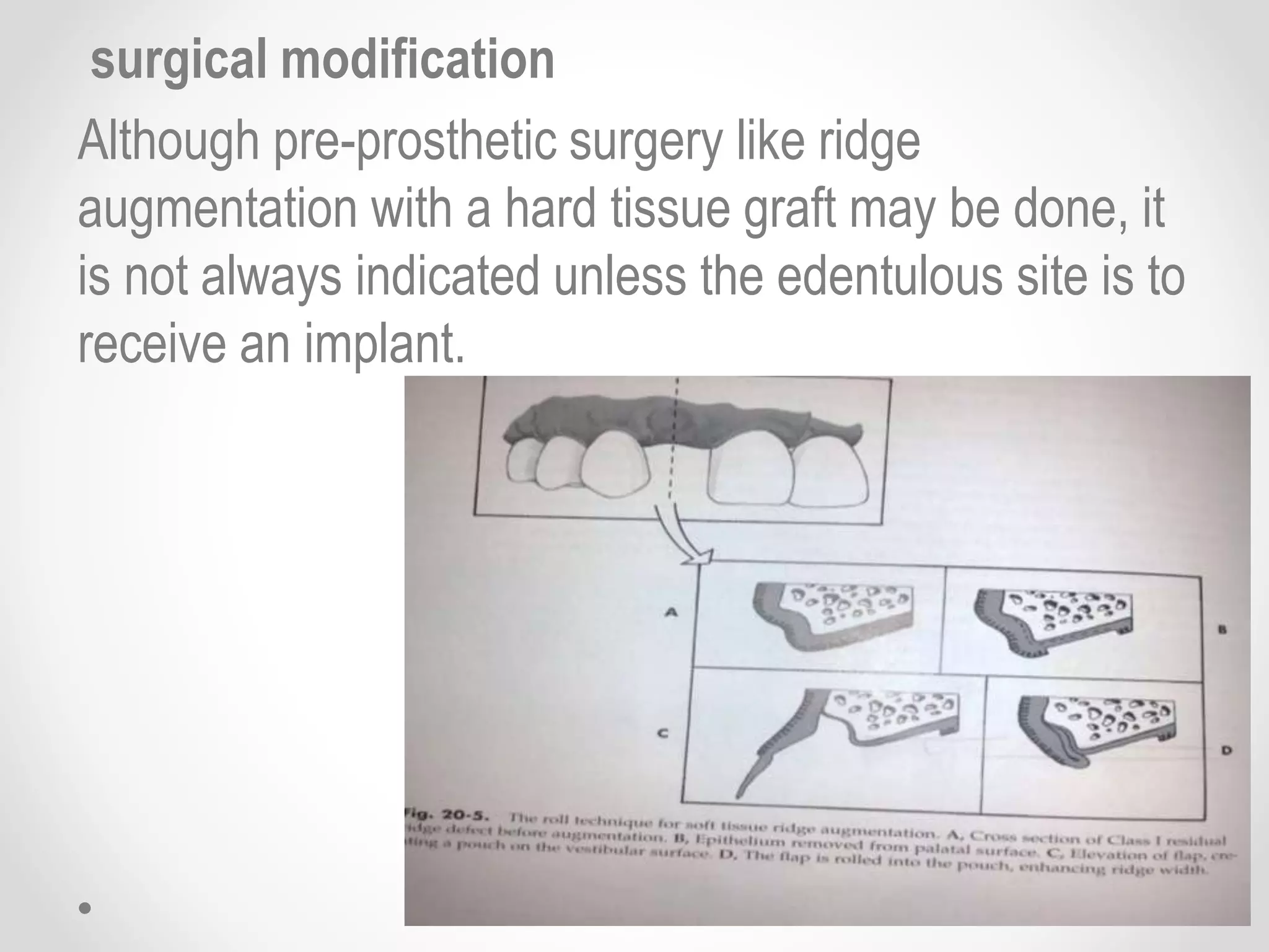 pontics in FPD (prosthodontics) | PPTX