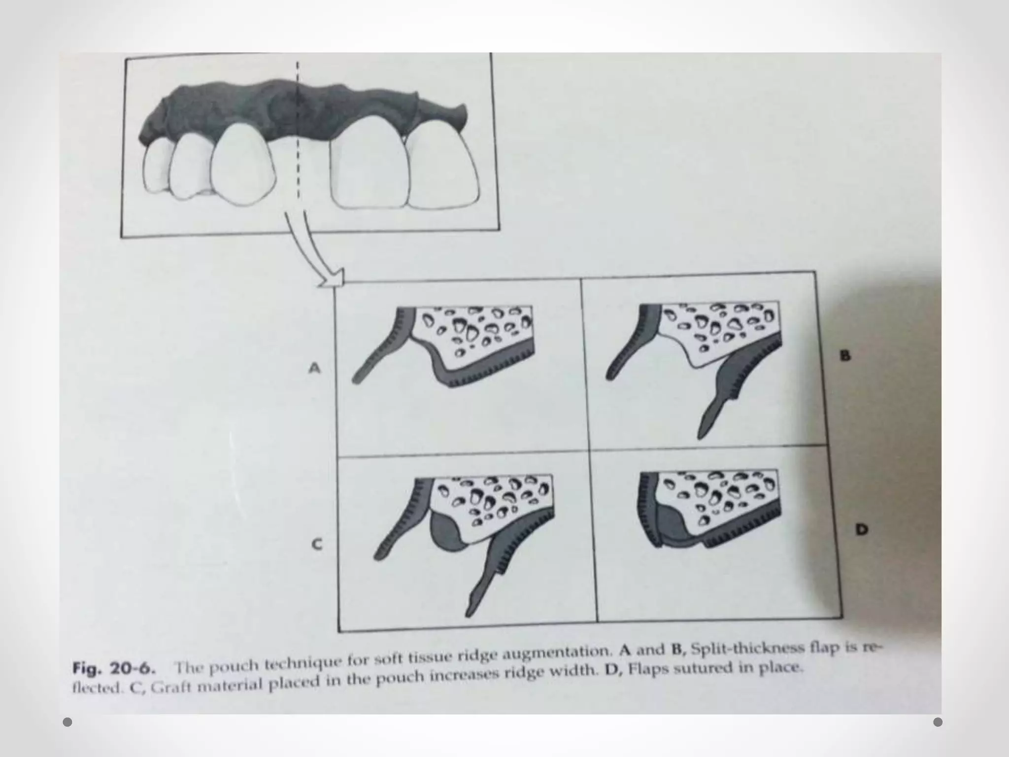 pontics in FPD (prosthodontics) | PPTX