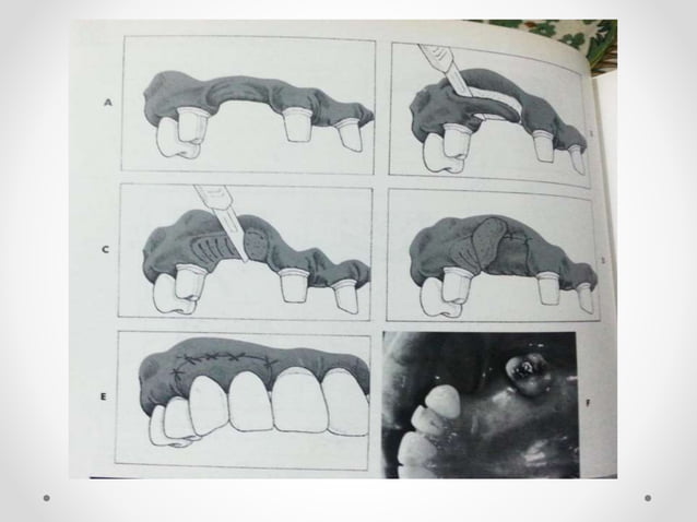pontics in FPD (prosthodontics) | PPTX | Dental Health | Diseases and ...