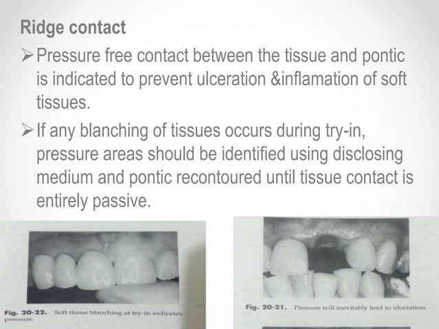 pontics in FPD (prosthodontics) | PPTX | Dental Health | Diseases and ...