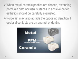 pontics in FPD (prosthodontics) | PPTX