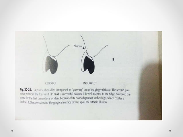 pontics in FPD (prosthodontics) | PPTX | Dental Health | Diseases and ...