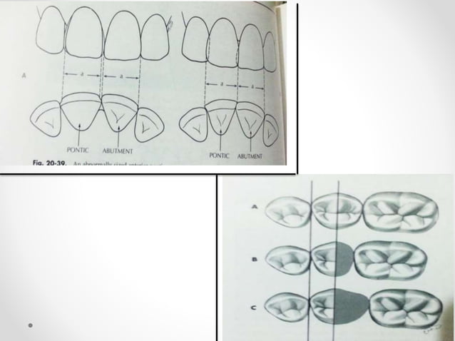 pontics in FPD (prosthodontics) | PPTX | Dental Health | Diseases and ...