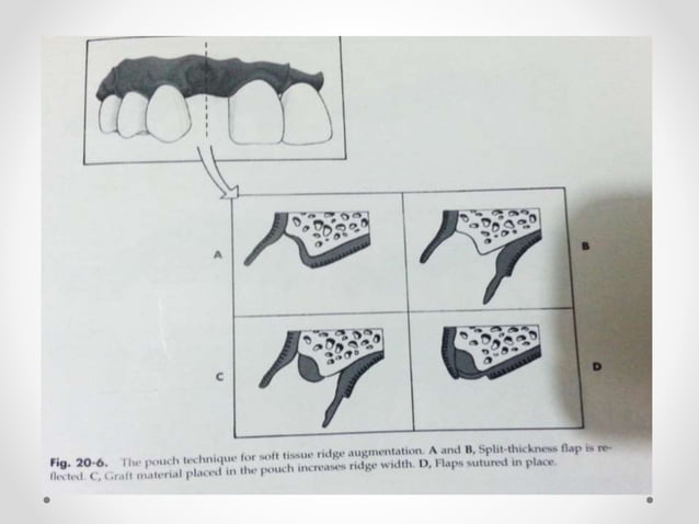pontics in FPD (prosthodontics) | PPTX | Dental Health | Diseases and ...