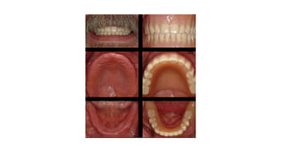 Prosthodontics - realeff relevance in complete denture | PDF