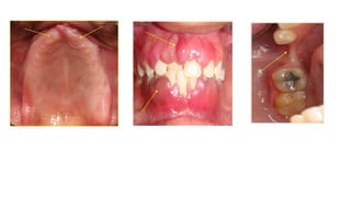 Prosthodontics - realeff relevance in complete denture | PDF