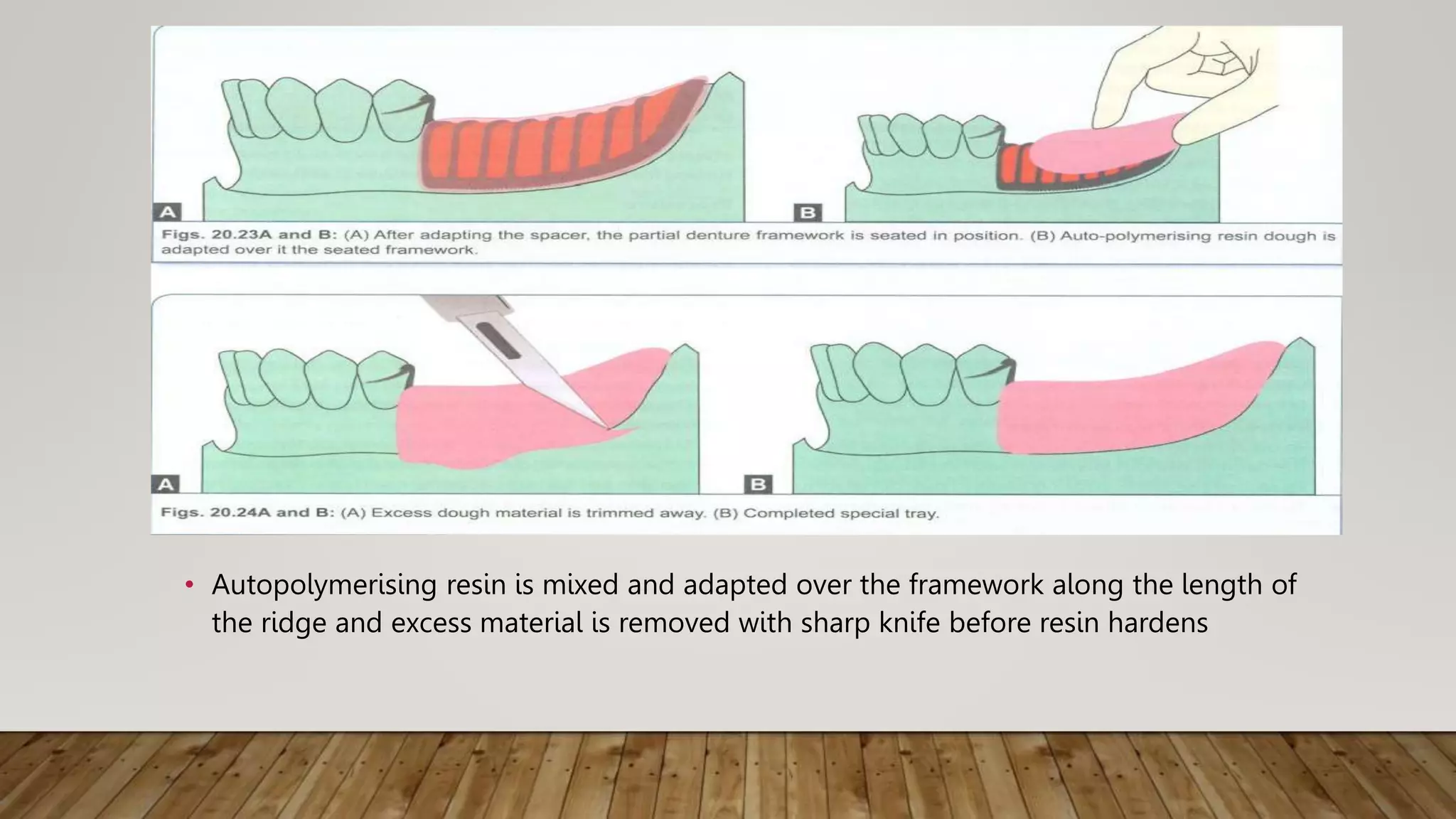 Functional impression in RPD | PPTX