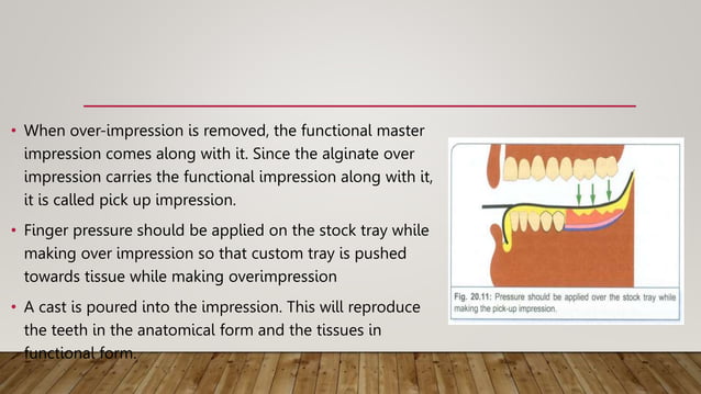 Functional impression in RPD | PPTX | Dental Health | Diseases and ...