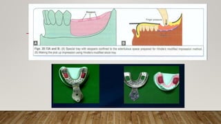 Functional impression in RPD | PPTX