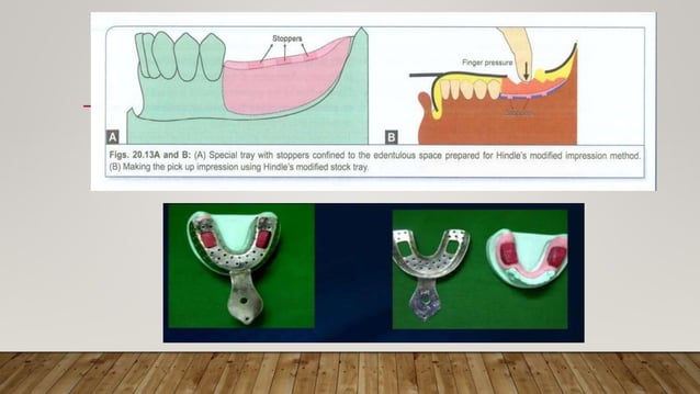 Functional impression in RPD | PPTX | Dental Health | Diseases and ...